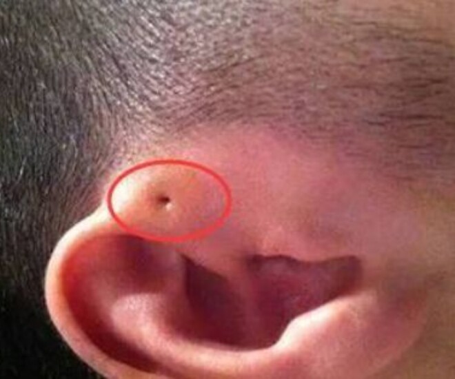 Mẹ phát hiện gần tai con xuất hiện một lỗ sâu khác thường liền tò mò ...